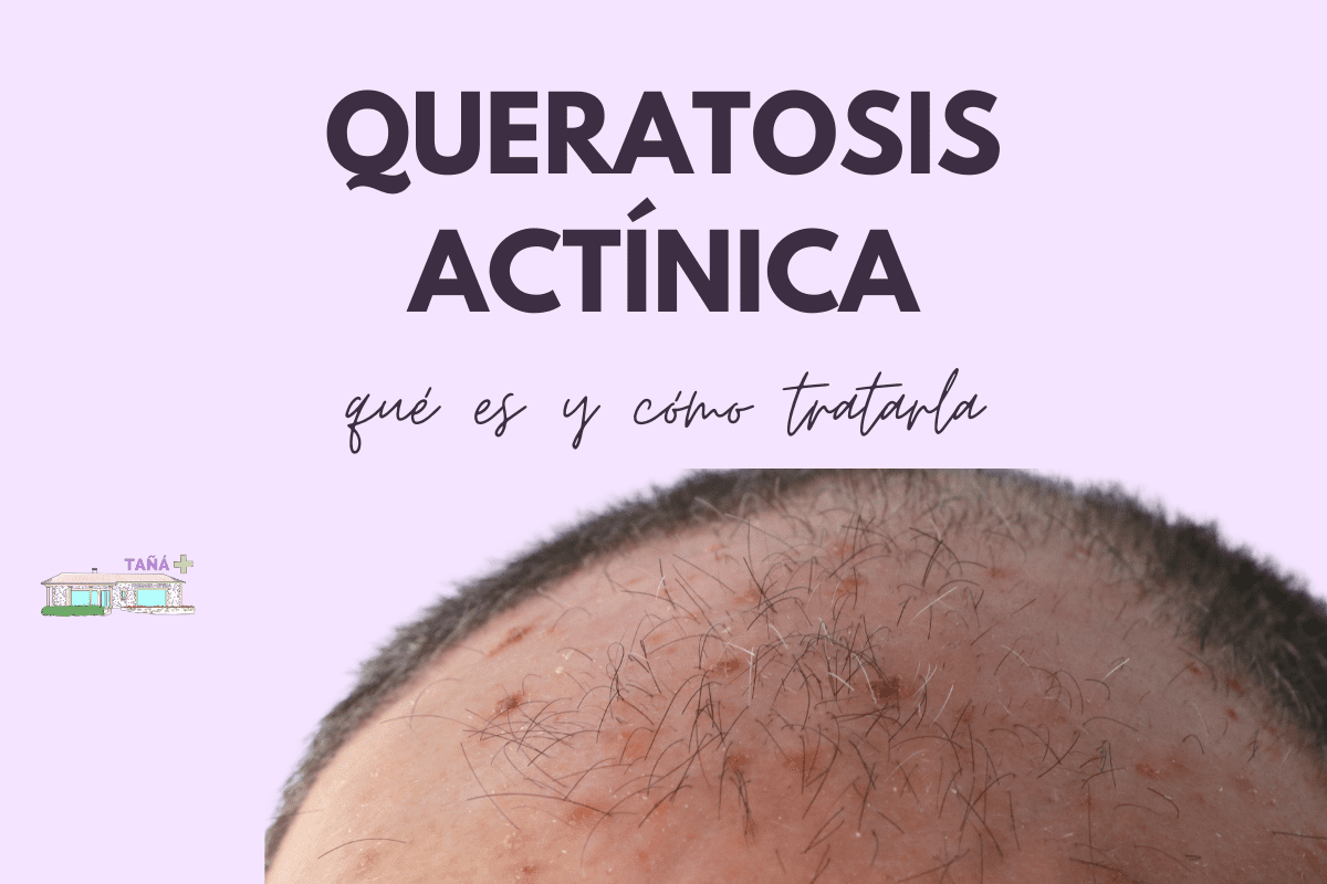 Queratosis actínica, ¿qué es? - El Blog Tañá